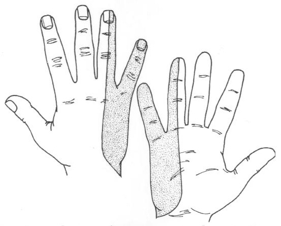 Pain in Pinky finger : Is this the Ulnar Tunnel Syndrome? - Life in a ...